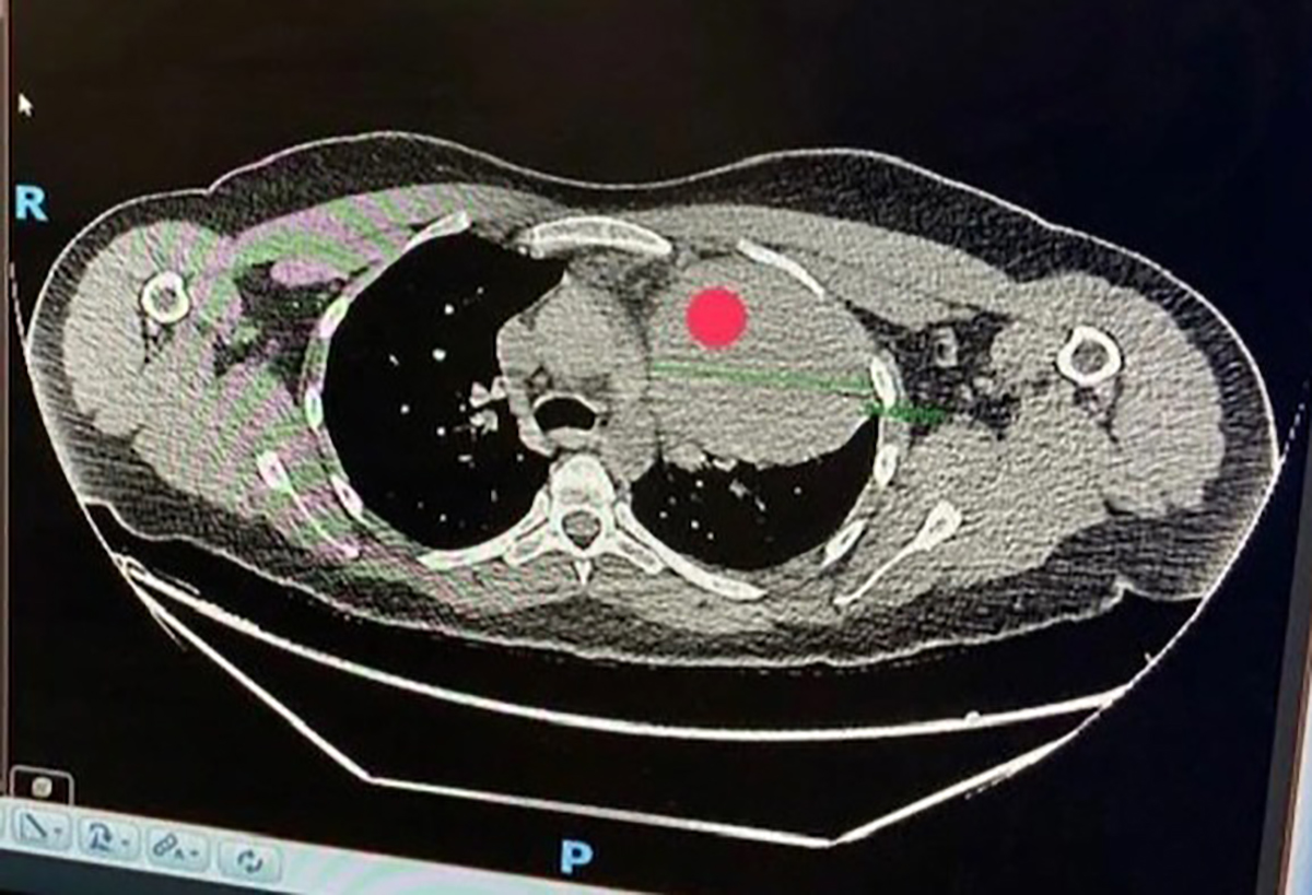 31-Year-Old Woman Now Has Eight Tumors & Stage Four Synovial Sarcoma ...