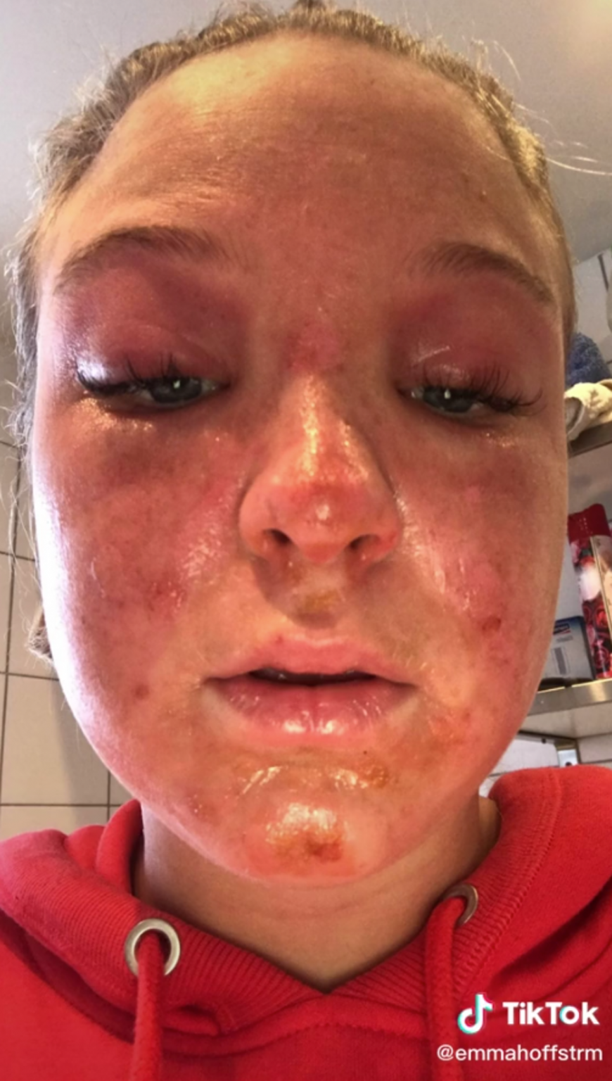 TikTok User Warns Of Tanning Bed Dangers After Suffering Severe Burns