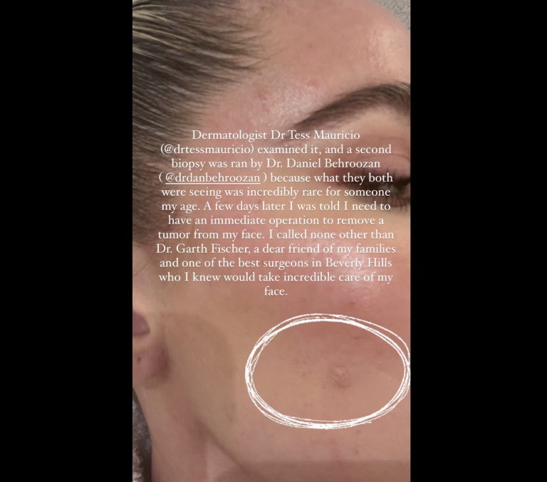 Khloe Kardashian Reveals Her Latest Skin Cancer Scare